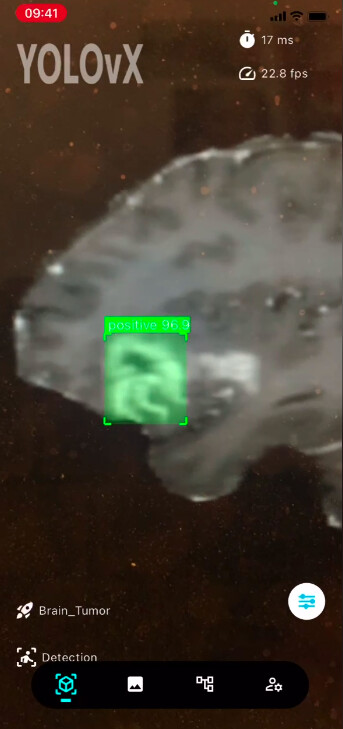 Experiment 3: Brain Tumor Detection on YOLOvX App - General - YOLOvX Forum