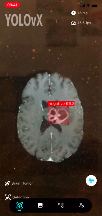 Experiment 3 Brain Tumor Detection On Yolovx App General Yolovx Forum